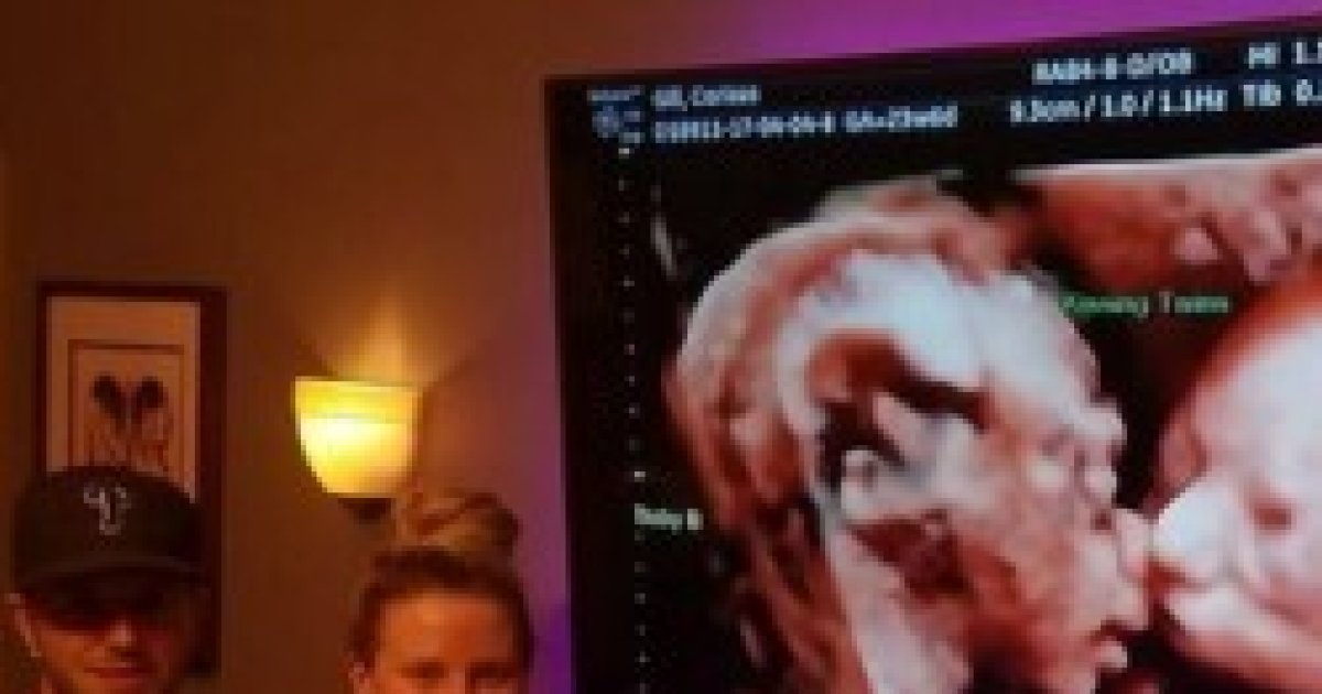 El tierno beso entre dos gemelas captado en esta ecografía emociona a ...